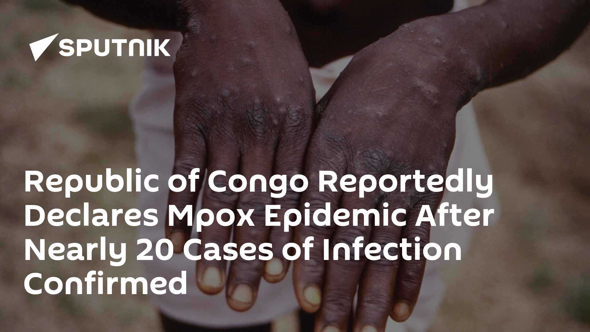 Republic of Congo Reportedly Declares Mpox Epidemic After Nearly 20 ...