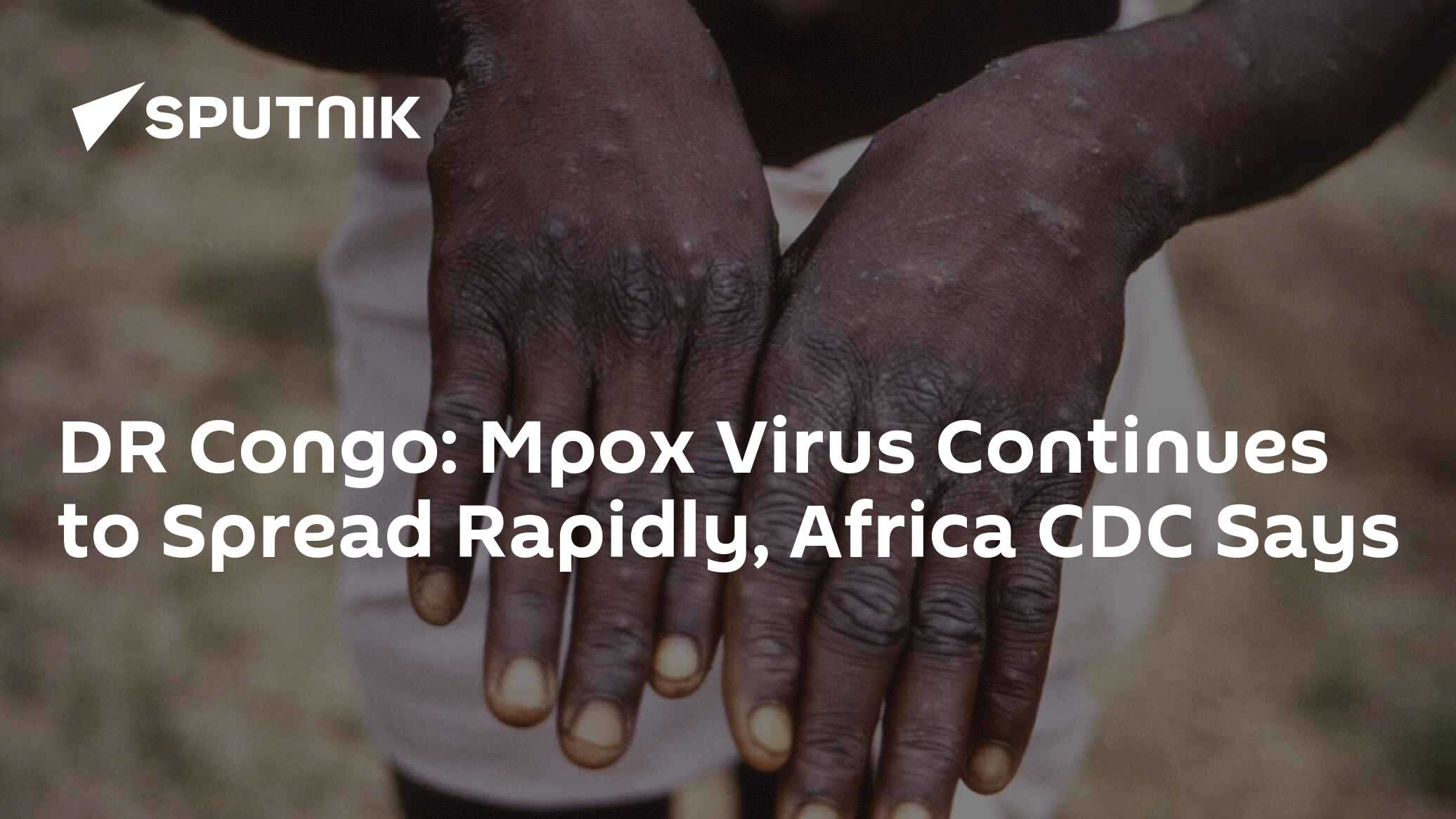 DR Congo: Mpox Virus Continues to Spread Rapidly, Africa CDC Says - 21. ...