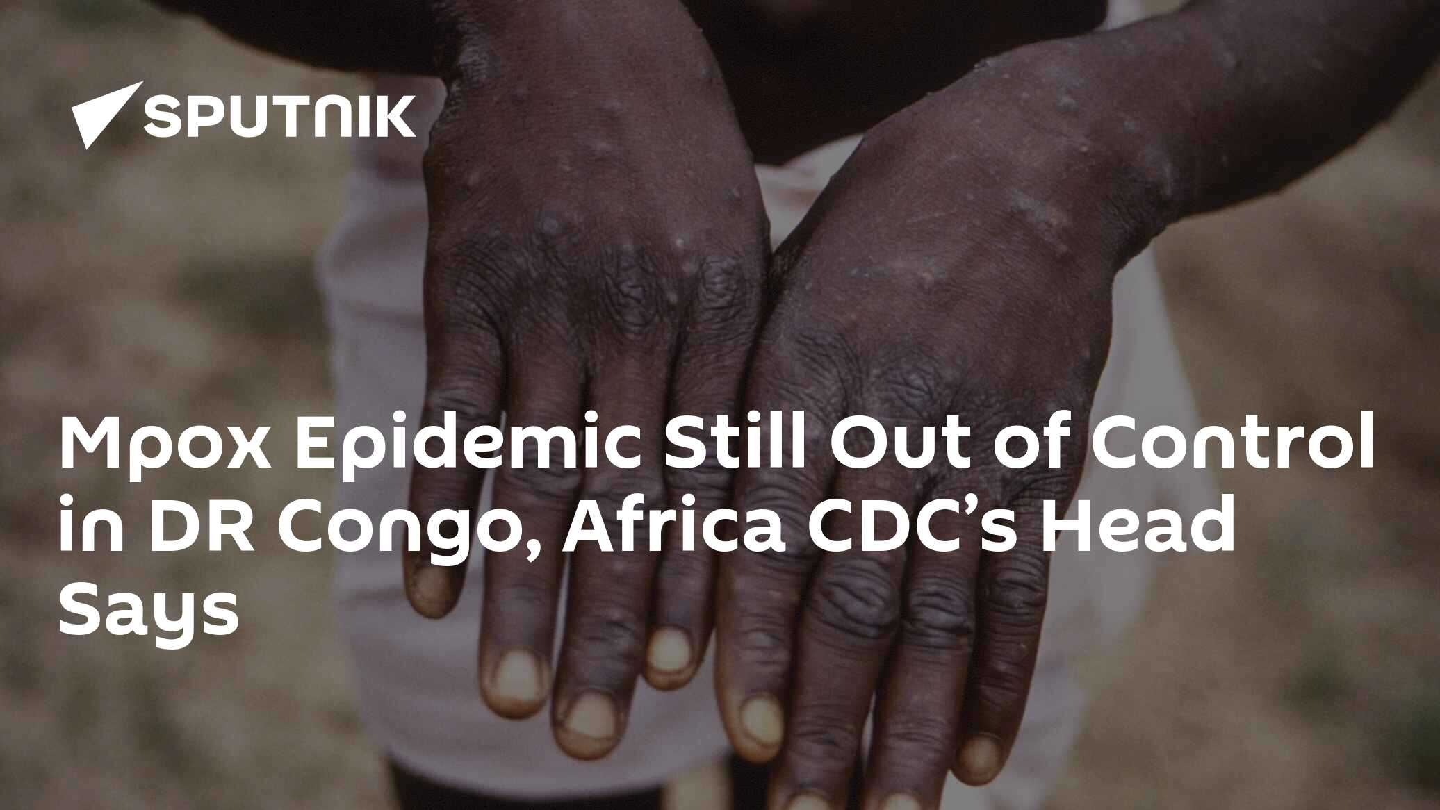 Mpox Epidemic Still Out of Control in DR Congo, Africa CDC’s Head Says ...