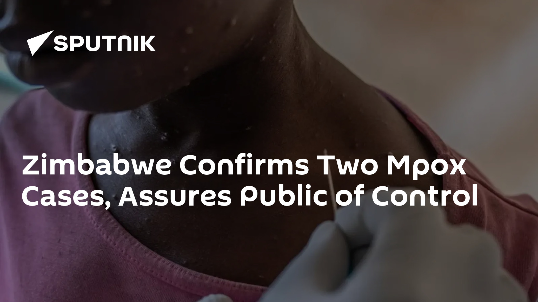 Zimbabwe Confirms Two Mpox Cases, Assures Public of Control - 14.10. ... Zimbabwe Confirms Two Mpox Cases, Assures Public of Control - 14.10. ...