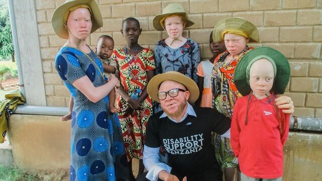 Zambia to Empower Advocacy For Albinism Rights - 06.10.2024, Sputnik Africa
